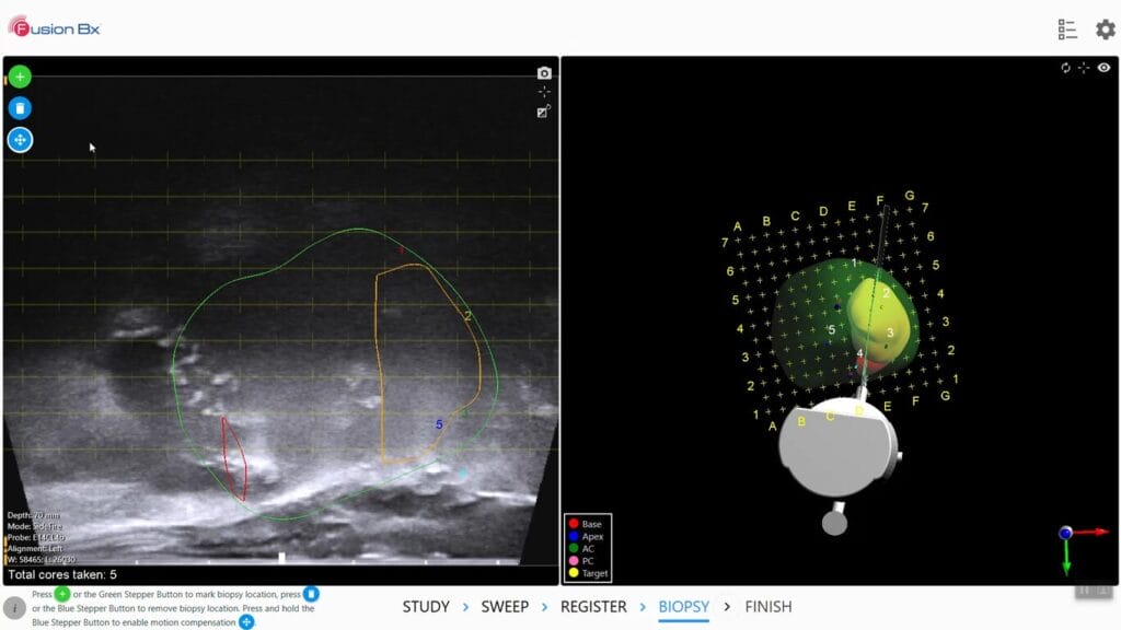 IRE Procedures with Fusion Bx 2.0 – Focal Healthcare